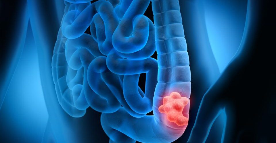 Esophageal Cancer and Tumors Symptoms & Causes – Laparoscopic cancer ...